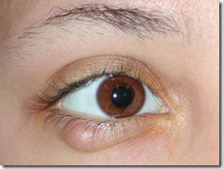 Global Eye Clinic: Know And Treat Your Eye Problems: Chalazion ...